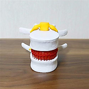Global-Dental Anatomical Herniated Lumbar Vertebrae Disc Prolapse Model Human Anatomy Model White