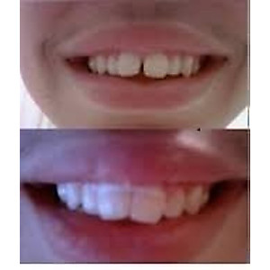 3/16 Inch Orthodontic Elastic Rubber Bands, 100 bands per pack, Natural, Heavy 4.5 Ounces Orthodontic Gap Teeth Bands by AdentalZ