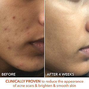 Dr. Dennis Gross Alpha Beta Extra Strength Daily Peel: for Oily Skin, Uneven Tone or Texture, Wrinkles or Enlarged Pores (30 Treatments)