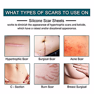 Silicone Scar Sheets (1.6” x 120” Roll-3M), Silicone Scar Tape Roll, Scar Silicone Strips, Reusable, Professional Scar Removal Sheets for C-Section, Surgery, Burn, Keloid, Acne et