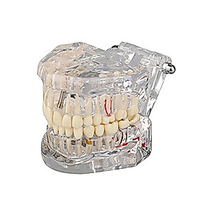 Ultrassist Transparent Disease Teeth Model with Dental Implant Bridge, Dental Model for Patient and Dental Student Education