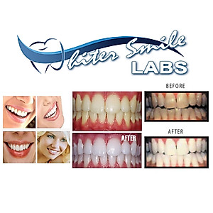 5 XL 38% Teeth Whitening Gel Dentist Recommended High Intensity Carbamide Peroxide Pro Dental Lab Direct, Sensitivity Free, Sold by Dentists, Whiter Smile Labs Fast WHITENING Results