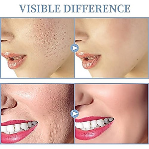 High Frequency Facial Machine - TUMAKOU Portable Handheld High Frequency Facial Skin Wand Machine with 4 Different Tubes