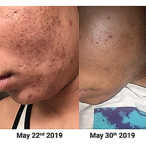 NxN Hyaluronic Acid Face Serum - Hydrate Skin, Boost Collagen, Reduce Lines & Wrinkles - All Skin Types