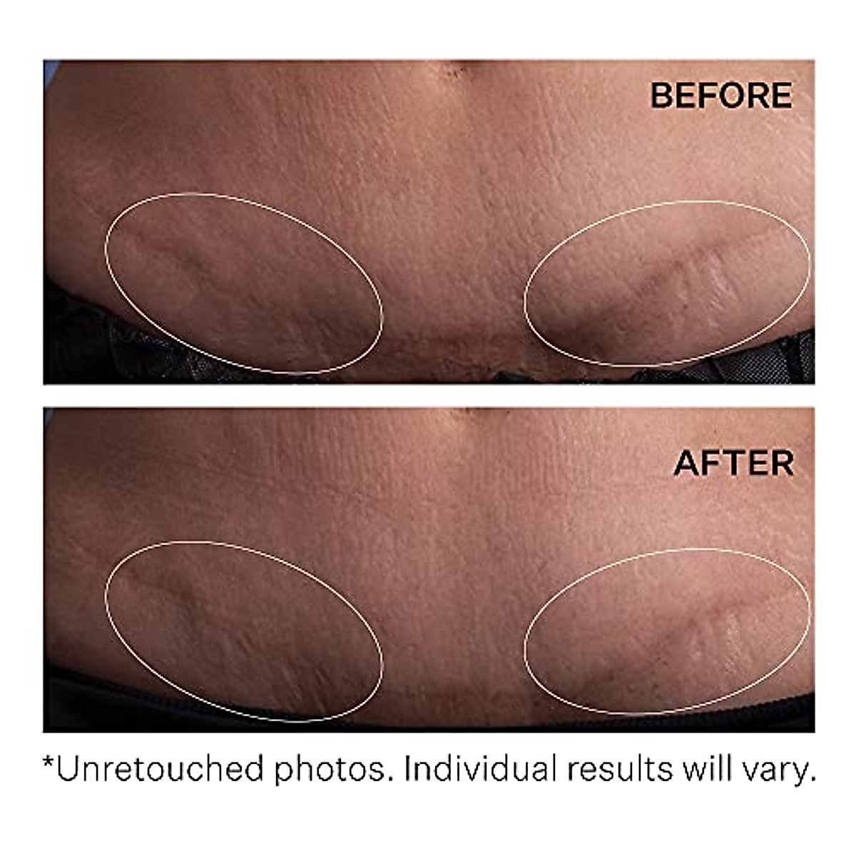 StriVectin Anti-Wrinkle SD Advanced PLUS Intensive Moisturizing Concentrate for Wrinkles and Stretch Marks with Collagen-Targeting Technology, 2 Fl Oz