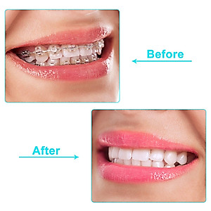 20 Pieces Aligner Tray Seaters for Aligner Trays Chompers Orthodontic Trays(Pink, Orange, Green, Purple, White)