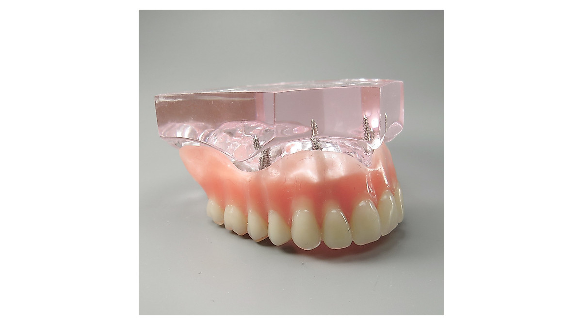 Dental Model Upper Overdenture with 4 Implants for Teaching