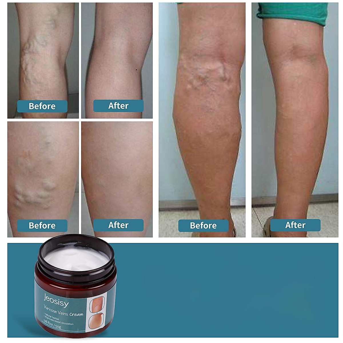 jeosisy Varicose Vein Cream - Varicose Veins Cream for Legs, Varicose & Spider Veins Soothing Leg Cream