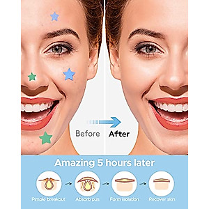 LitBaer Star-Shaped Pimple Patch Hydrocolloid Acne Stickers with Tea Tree Oil + Salicylic Acid, Cover Dot for Acne Blemish, Pimples, Whiteheads, Zit, Draw out Oil & Impurities, 112 Dots, 14mm & 10mm