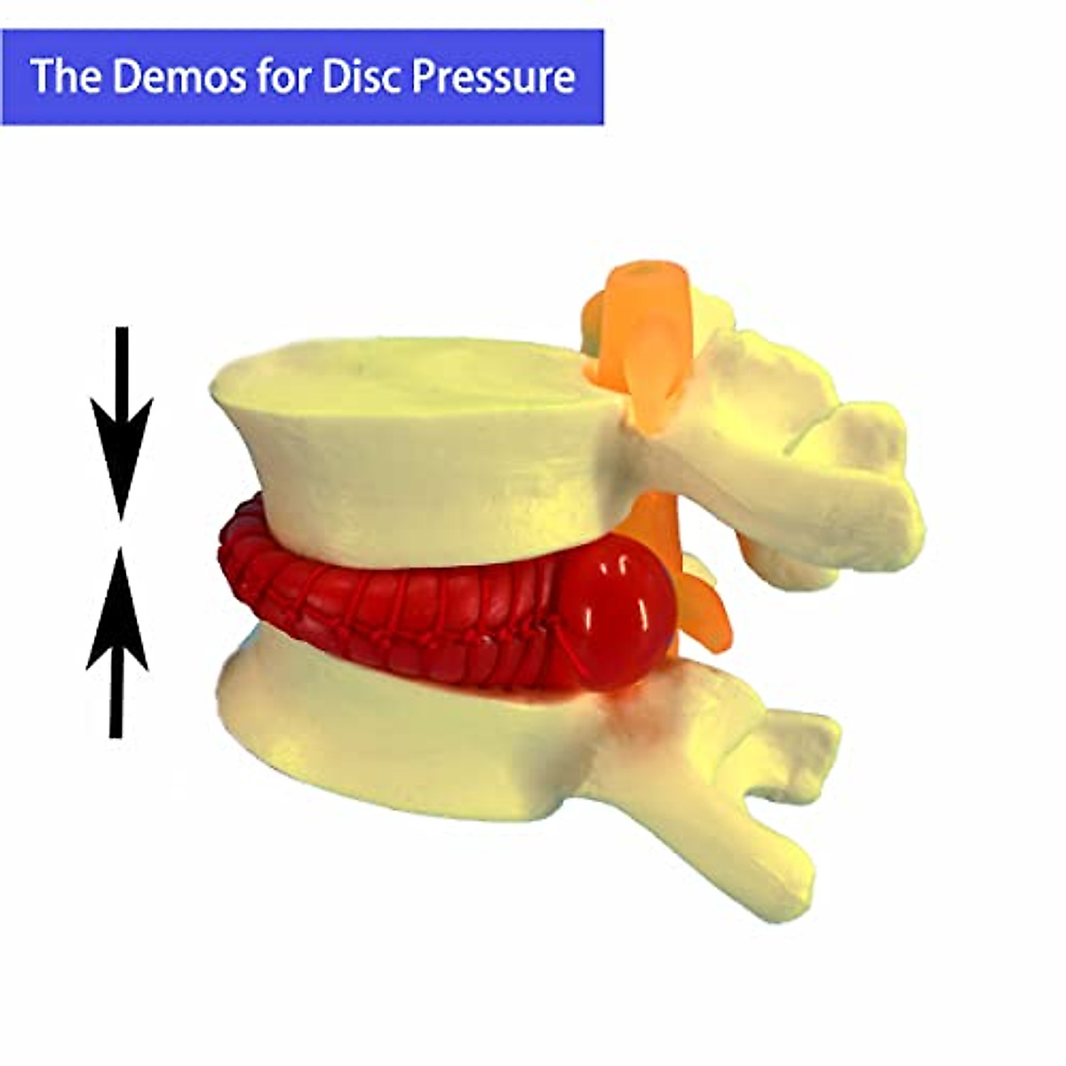 Veipho Human Anatomical Lumbar Disc Herniation Model, 1.5 Times Life Size Lumbar Disc Herniation Model, Human Lumbar Disc Herniation Model for Teaching, Learning, Demonstrating