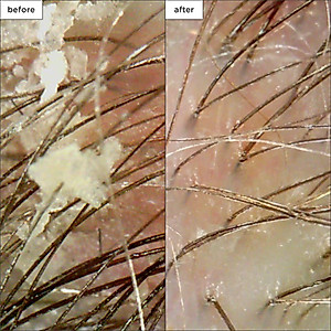 Briogeo Scalp Revival Micro-Exfoliating Shampoo and Charcoal + Tea Tree Scalp Treatment, Vegan, Phalate & Paraben-Free