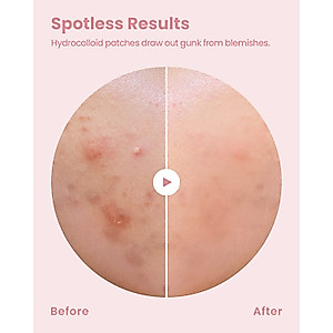 GLAM UP Hydrocolloid Blemish Pimple Zit Patches - Invisible Ultra Thin Spot Cover Stickers for Face and Skin, Strong Water-proof and Adhesive Overnight, Vegan-friendly (72 Count / 2 Sizes)