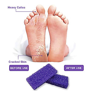 BPrettier Foot Pumice Stone Pumice Stone for Feet Foot Scrubber Sponge Callus Remover Dead Skin,Pedicure Supplies Nail Salon Home Use 40 PCS