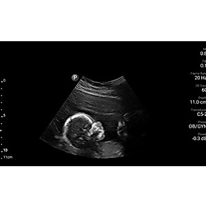 Philips Lumify C5-2 Curved Array Transducer, Portable Ultrasound Solution