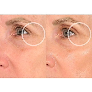 SiO Beauty Eye & Smile Lift - Eye & Smile Anti-Wrinkle Patches 2 Week Supply - Overnight Smoothing Silicone Patches for Wrinkles and Fine Lines