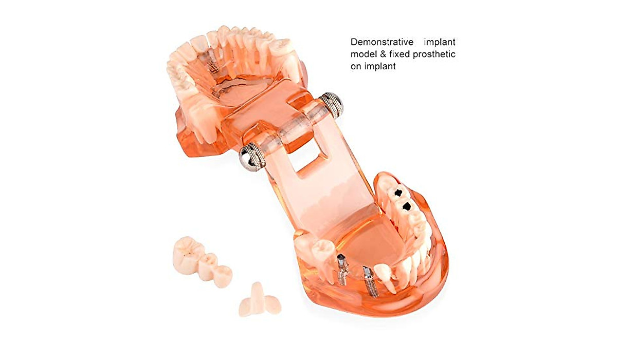 Maxmartt Dental Implant Study Model for Education and Communication