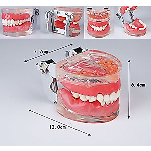 Dental Teeth Typodonts Model for Parodontopathy Periodontal Disease, Removable Gingivae Pathology Teeth Model Used in Teaching,Explain,Studying for Adult(Transparent)