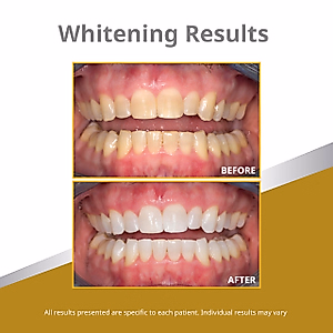 Opalescence 45% Syringes Teeth Whitening Gel - with PF - (4 Syringes) Refill Kit Carbamide Peroxide. Made by Ultradent, in Mint Flavor. Tooth Whitening 5359-2