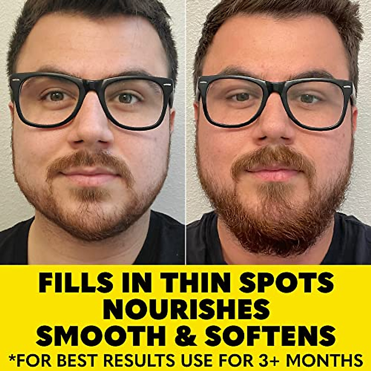 Beard Club - Beard Growth Oil - Grow A Thicker Fuller Beard, Fill in Patches - Healthy Natural Castor, Coconut and Avocado Beard Growth Serum to Stimulate Thicker, Fuller, Healthier Facial Hair Growth