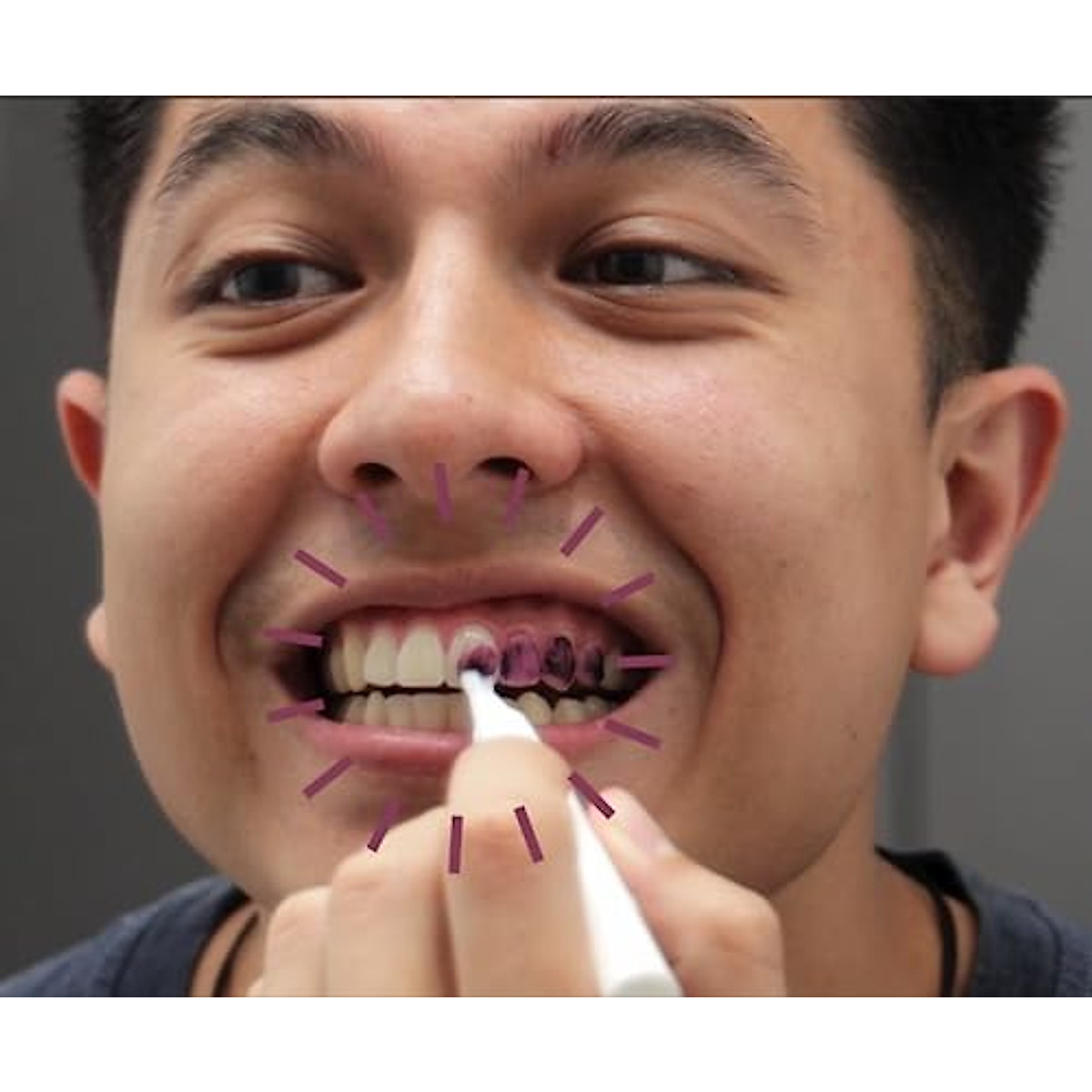 Plaque Disclosing Gel Pens for Teeth, 150 Uses, Dental Disclosing Tablet Gel for Kids & Adults - Shows Plaque, Helps Teach Kids Teeth Brushing Habits for Clean Teeth - by Idyll