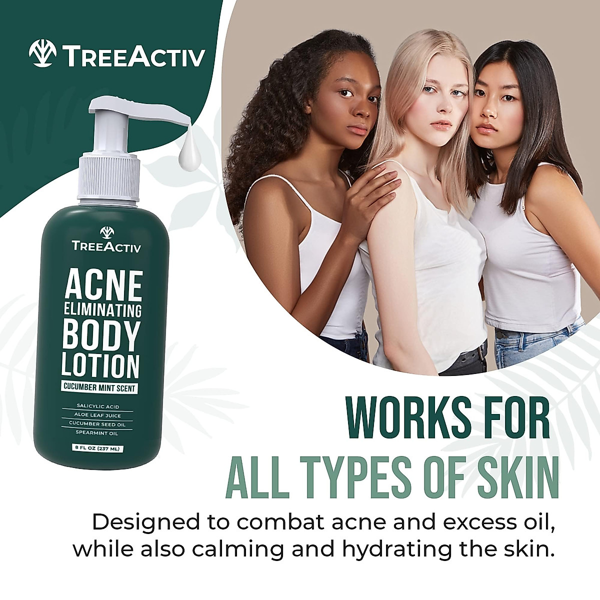 TreeActiv Acne Eliminating Body Lotion, 8 fl oz, Salicylic Acid Lotion, Salicylic Acid Body Acne Treatment, Back Acne Treatment Cream for Women and Men, Acne Lotion for Body, Zit Cream with 2000+ Uses