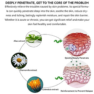 Heat Rash Itch Relief, Extra Strength Cream, Jock Itch, Athlete's Foot Hand Skin, Tinea Versicolor, Armpit, Itchy Feet, Psoriasis, Scalp Dandruff, Fast Relief for Eczema, Rosacea, 24h Soothing Treat