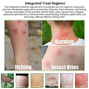 Heat Rash Itch Relief, Extra Strength Cream, Jock Itch, Athlete's Foot Hand Skin, Tinea Versicolor, Armpit, Itchy Feet, Psoriasis, Scalp Dandruff, Fast Relief for Eczema, Rosacea, 24h Soothing Treat