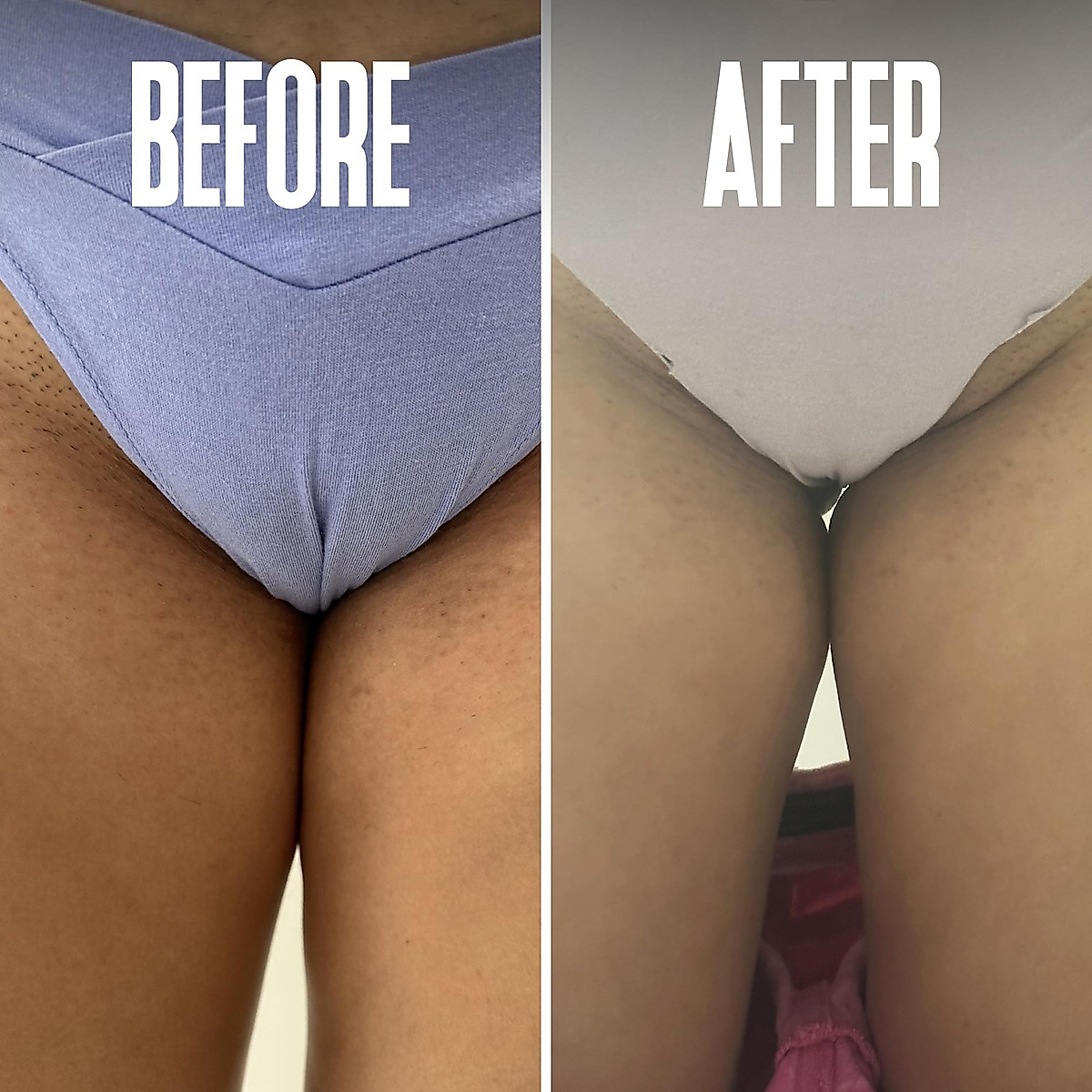 Prevent Ingrown Hairs and Razor Bumps with BHA & AHA Pads - Ingrown Hair Serum for Razor Burns - PFB Razor Bump Stopper Topicals Skin Care, Ingrown Hair Treatment for Bikini Area and Razor Bumps