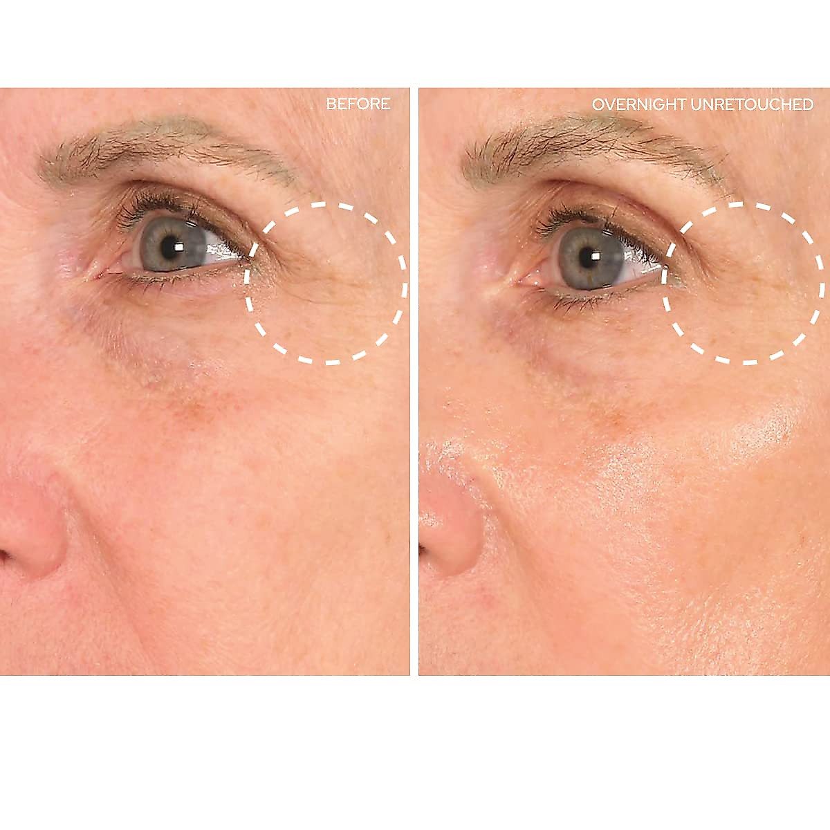 SiO Beauty Eye and Smile Lift Anti-Wrinkle Patches 4 Week Supply - Overnight Under Eye Mask Pads For Dark Circles - Silicone Skin Treatment For Wrinkles