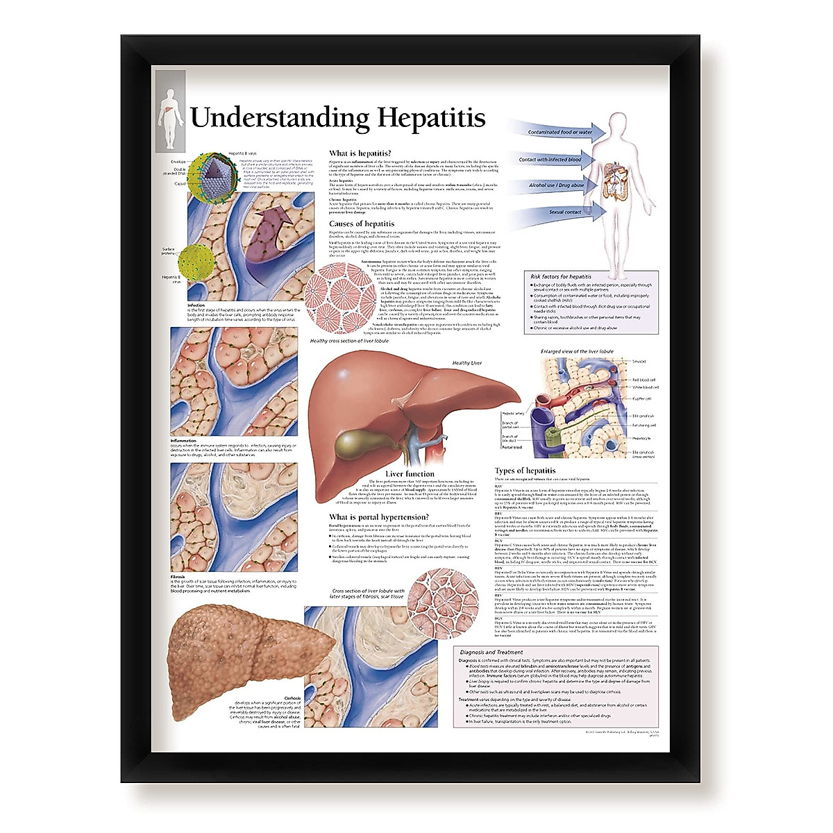 Set of 4 Framed Medical Posters Understanding Diabetes Understanding Cholesterol Understanding Metabolic Syndrome and Understanding Hepatitis 22"x28" Wall Diagrams