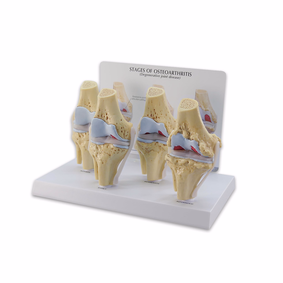 GPI Anatomicals Knee Joint Model Set | Human Body Anatomy Replica Set of 4-Stage Osteoarthritis Knee Joint for Doctors Office Educational Tool