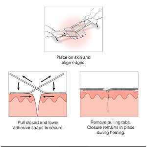 Clozex Emergency Laceration Closures - Repair Wounds Without Stitches. FDA Cleared Skin Closure Device for 3 Individual Wounds Or Combine for Total Length of 4 1/4 Inches.