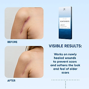 Silicone Scar Removal Sheets - Breathable Reusable & Waterproof Keloid Scar Removal Patches Caused by C-Section, Surgery, Burn, Acne, Stretch Marks Healing Alternative to Gel, Tape & Cream (4 sheets)