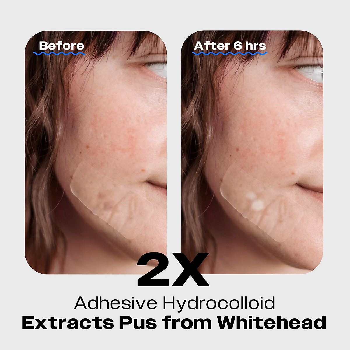 AVARELLE ZITOUT Large Hydrocolloid Pimple Strips (16 Patches) | Vegan Nose Patches for Pores Tea Tree | Chin Acne Patches for Face | Hydrocolloid Bandages for Acne | FSA & HSA Acne Treatment