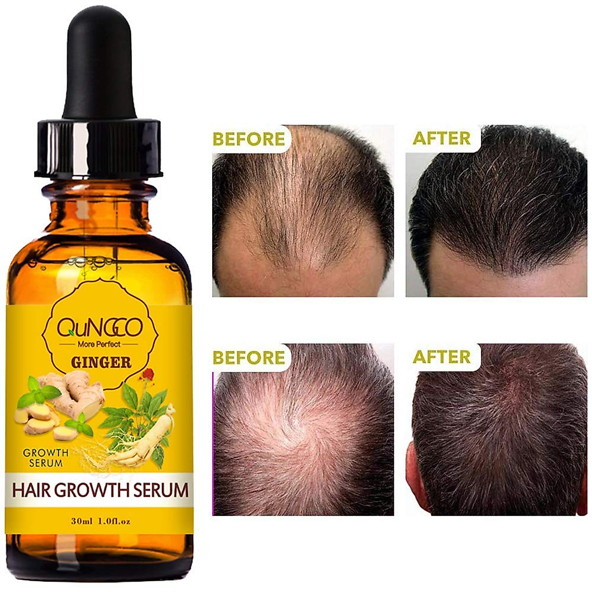 5 Pack Hair Growth Serum,Ginger Biotin Hair Regrowth Serum Prevent Hair Loss and Natural Serum for Thicker, Stronger, Longer Hair Men and Women