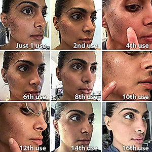 Stop Guessing Cleanser for Melasma Treatment - Fast Dark Spot Remover/Age Spot Remover