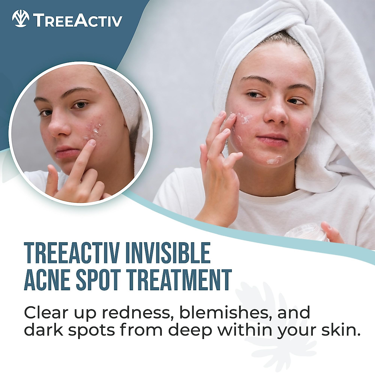 TreeActiv Invisible Acne Spot Treatment, 150+ Treatments, Salicylic Acid & Tea Tree Oil No Show Spot Treatment for Cystic & Hormonal Acne, Works for Blackheads & Whiteheads