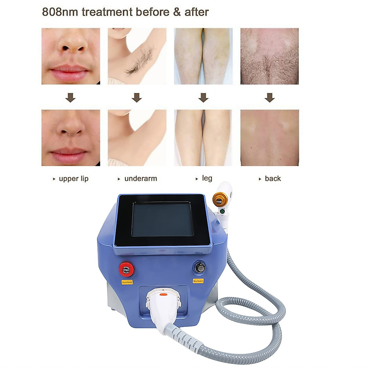 Portable 808 Diode Hair Removal Machine (3 wavelengths: 755nm/ 808nm/ 1064nm)