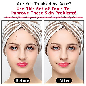 Xesscare Pimple Popper Tool Kit 7 Pcs Blackhead Remover Tool Comedones Tweezers Acne Extractor Blemish Whitehead Removal Tool for Facial, Nose and Forehead (Silver)