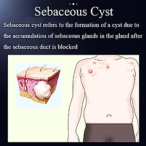 Model Teaching Model Cyst Model Skin Cyst Excision Model Training Suture Pad Skin Model Lipoma Model for Medical Practice for Teaching