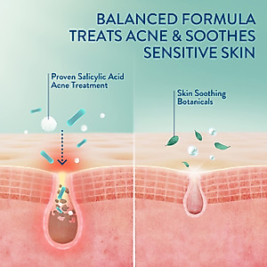 Cetaphil Acne Clearing Kit - Clarifying Acne Cream Cleanser (4.2 oz) & Mattifying Acne Moisturizer (3 oz) with Salicylic Acid, Deep Clean, Hydrate and Treat Sensitive Acne Prone Skin