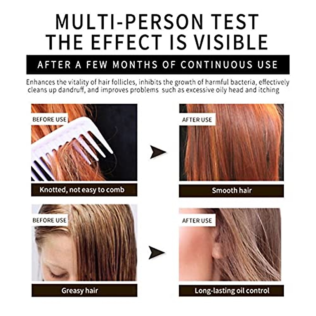 2 PC-ONIYEA Natural Handmade Shampoo Bar Soap, Oil Control, Deep Cleaning, Improve Acne On Scalp, 100% Organic Plant Extract Hair Wash, Women Men, Eco-friendly 1.92 Oz Each (TEATREE)