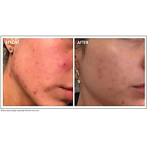 Glowbiotics Probiotic Acne Cleanser: Gentle Foaming Face Wash for Acne-Prone Skin | Clears Pores, Removes Dirt & Oil, Soothes Redness with Salicylic Acid & Niacinamide