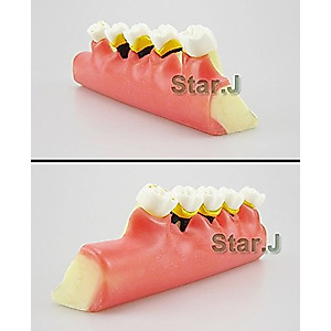 Dental Periodontal Disease assort Tooth Teeth Typodont Study Teaching Model New
