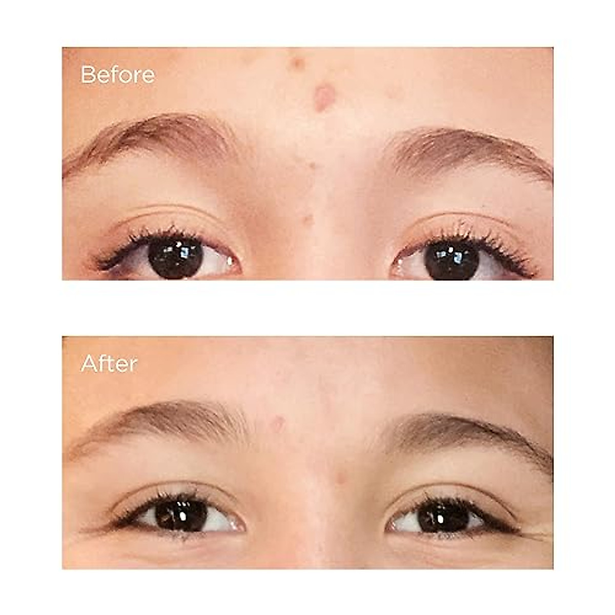 Perricone MD Acne Relief Prebiotic Acne Therapy