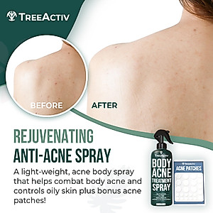 TreeActiv Body Acne Treatment Spray, 8 fl oz, 2% Salicylic Acid Spray for Body, Back Acne Treatment Spray with Tea Tree Oil and Aloe Vera, Gentle Back Acne Spray that Clears Body Acne, 2000+ Uses