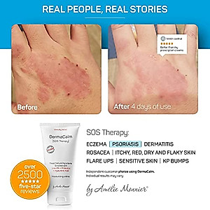 Clinically Tested Cream for Eczema, Dermatitis and Psoriasis Treatment - Urea 8%, Probiotics w/Best Natural Ingredients - Face & Body Moisturizing Lotion - Itchy, Severely Dry, Scaly Skin. Rash Relief. Moisturizer for Adults & Kids