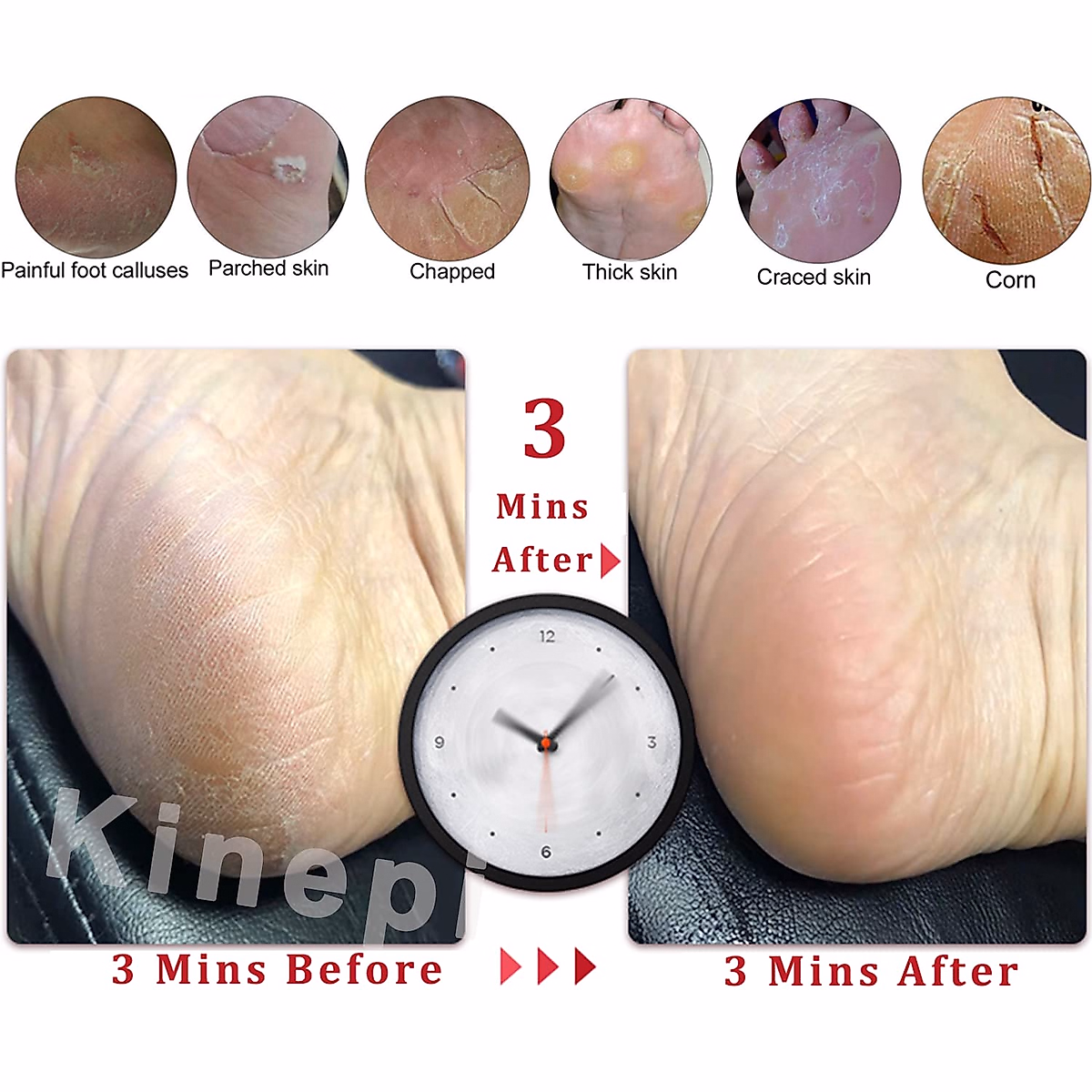 Kinepi Feet Callus Removers Professional Colossal Foot Scrubber Pedicure Foot File Foot Massager Pumice Stone for Feet,Remover Corn Hard Skin Dead Skin Exfoliator for Use in Shower Feet Care Tools
