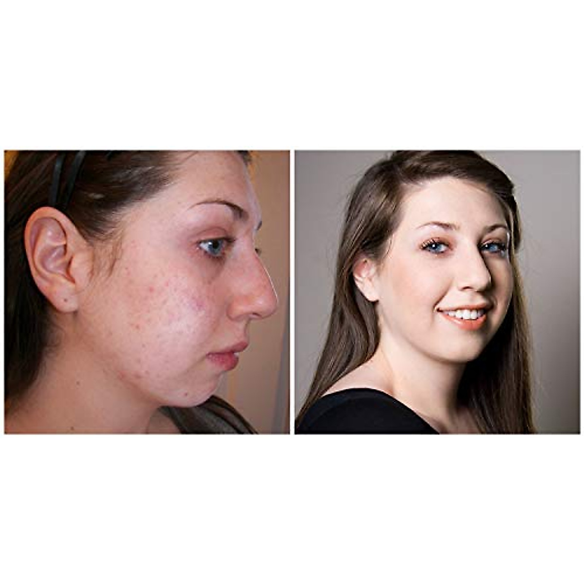 The EraseZit Pencil Deluxe- Neutral Light