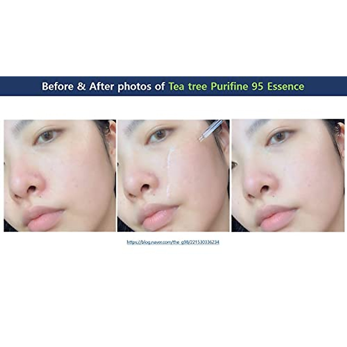 Dr.Ceuracle Tea Tree Purifine EssenceㅣThe Mildest Serum with 95% Tea Tree Extract ㅣLightweight Moisturizer for Returning Skin's Natural Vitality, ComplexionㅣIntensive Care for Calming Skin Trouble, Acne